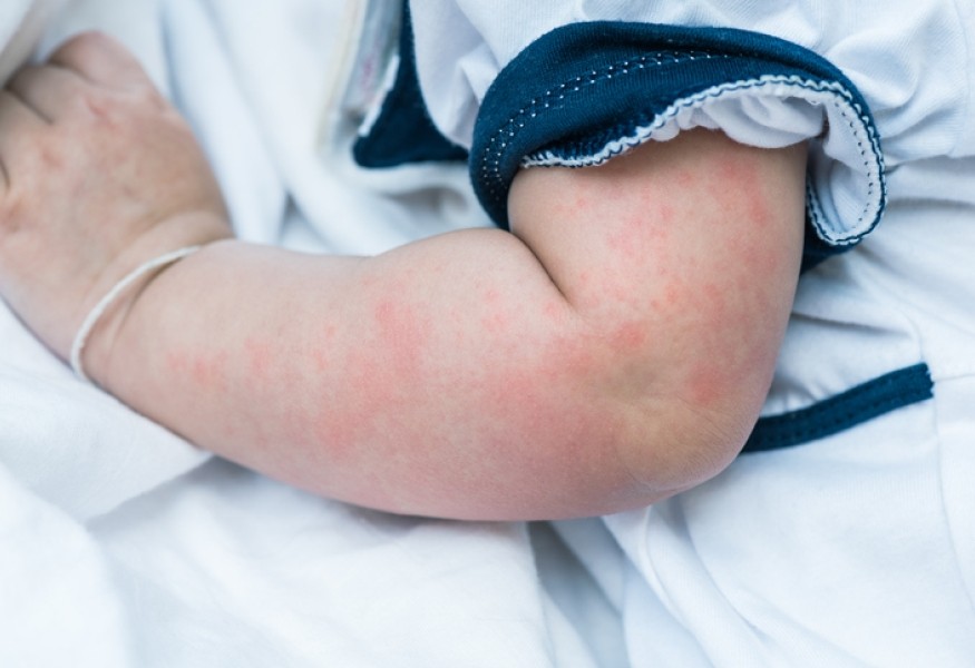 Hives, Hives and More Hives! | Texas Children's