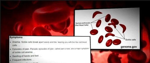 Sickle cell disease advocates in Texas push for better data tracking ...