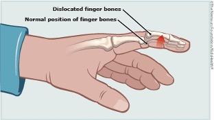Dislocated Finger | Texas Children's