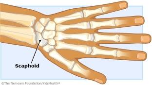 Scaphoid Fracture Texas Children S