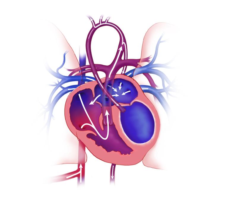 Hypoplastic Left Heart Syndrome (HLHS) | Texas Children's