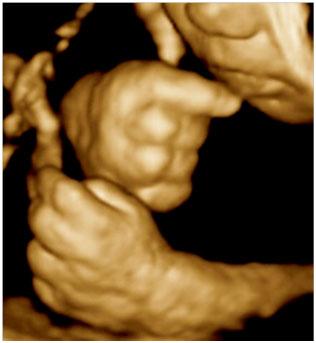 3-D and 4-D Ultrasound | Texas Children's