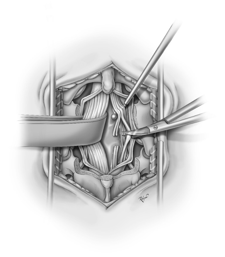 Selective Dorsal Rhizotomy Procedures | Texas Children's