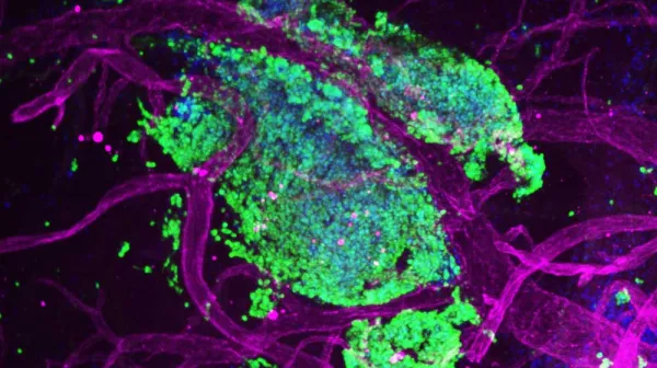 Disruption of MTSS2 function causes a new syndromic intellectual ...