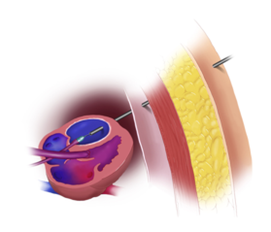 Balloon Dilation of Aortic Valve | Texas Children's
