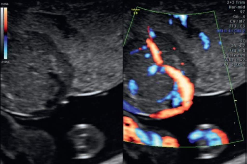 Chorioangioma | Texas Children's