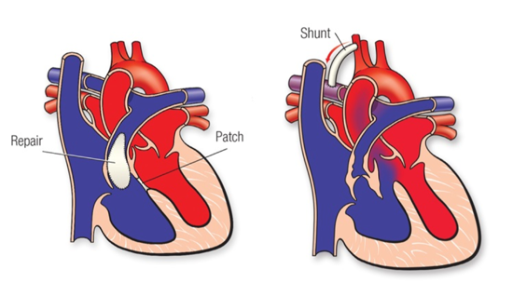 Tetralogy of Fallot | Texas Children's