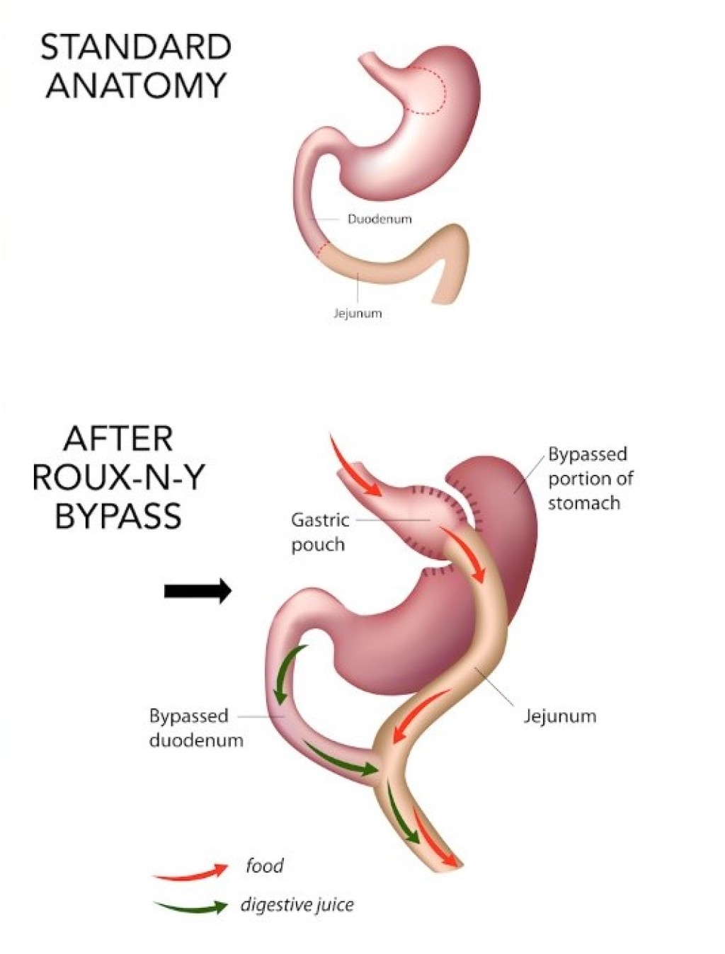 Bariatric Surgery Program Types of Bariatric Surgeries | Texas Children's