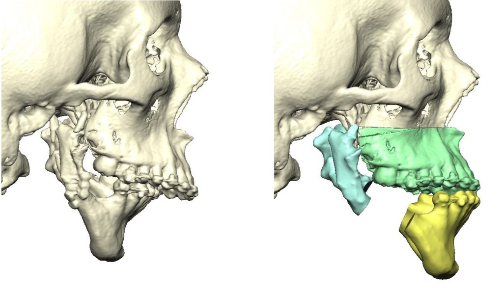 Jaw Surgery for Obstructive Sleep Apnea (OSA) at North Austin Campus ...