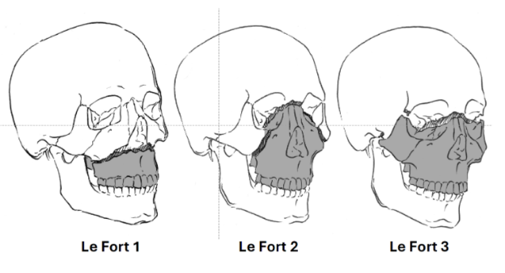 What is a “Le Fort” Osteotomy? at North Austin Campus | Texas Children's