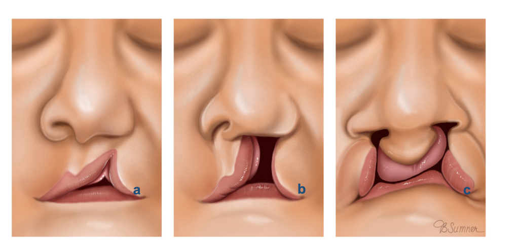 Cleft Lip and Palate at North Austin Campus | Texas Children's