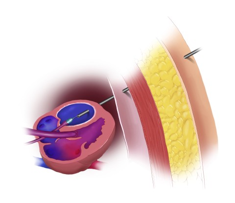 Hypoplastic Left Heart Syndrome (HLHS) | Texas Children's