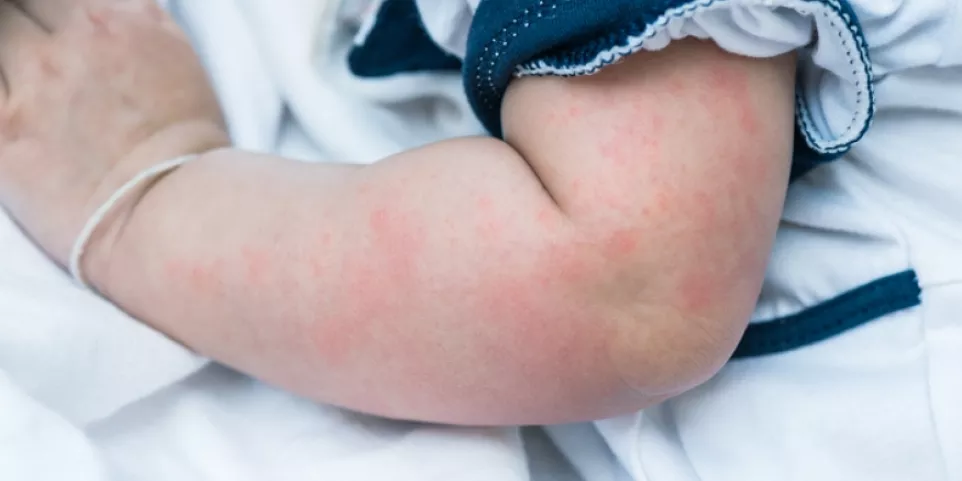 Hives, Hives and More Hives! | Texas Children's