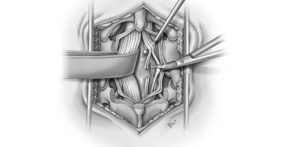 Selective Dorsal Rhizotomy Procedures | Texas Children's