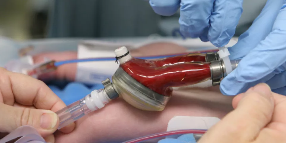 Unprecedented Study Shows Berlin Heart Device Provides Lifesaving ...