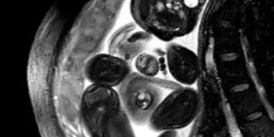 ectopia cordis life expectancy