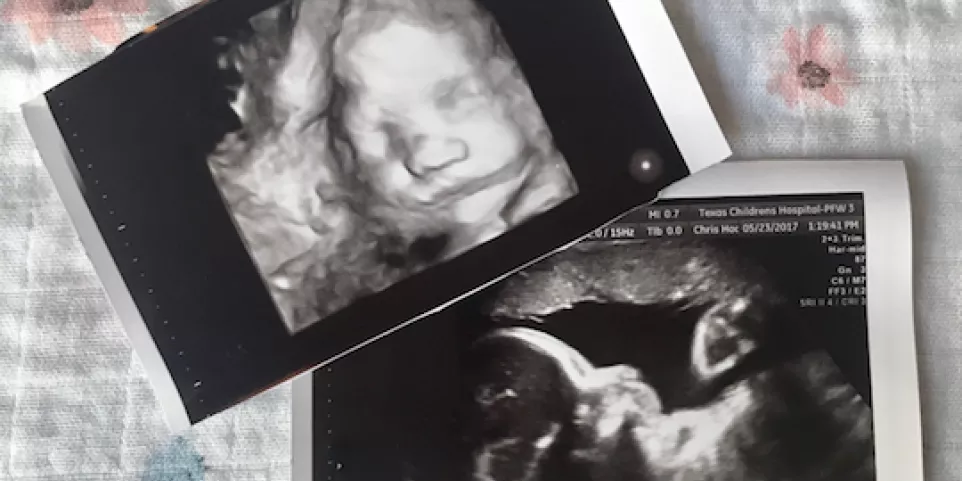 19 Week Anatomy Ultrasound From Georgia To Houston: Our Spina Bifida
