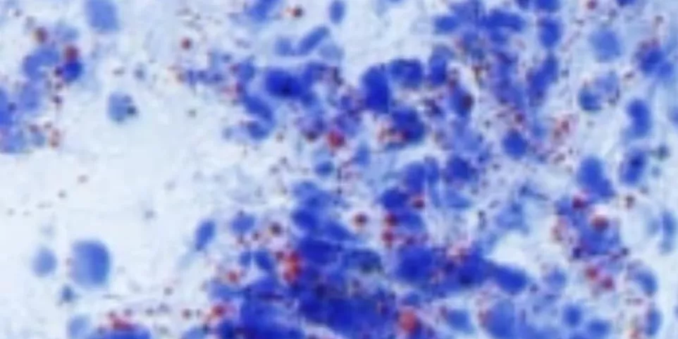 Neuroblastoma, a childhood cancer that develops from neural cells on ...