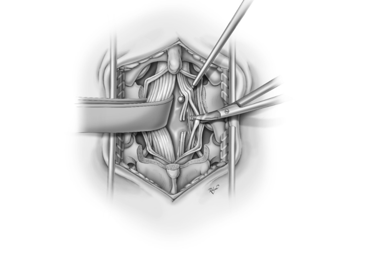 Selective Dorsal Rhizotomy Procedures | Texas Children's