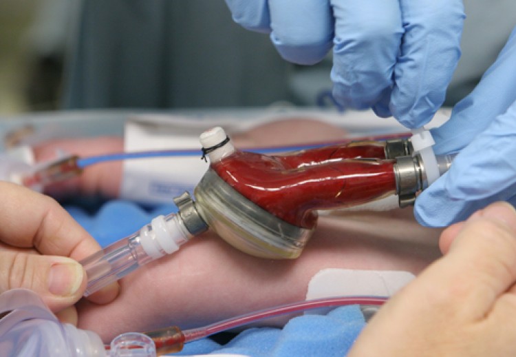 Unprecedented Study Shows Berlin Heart Device Provides Lifesaving ...