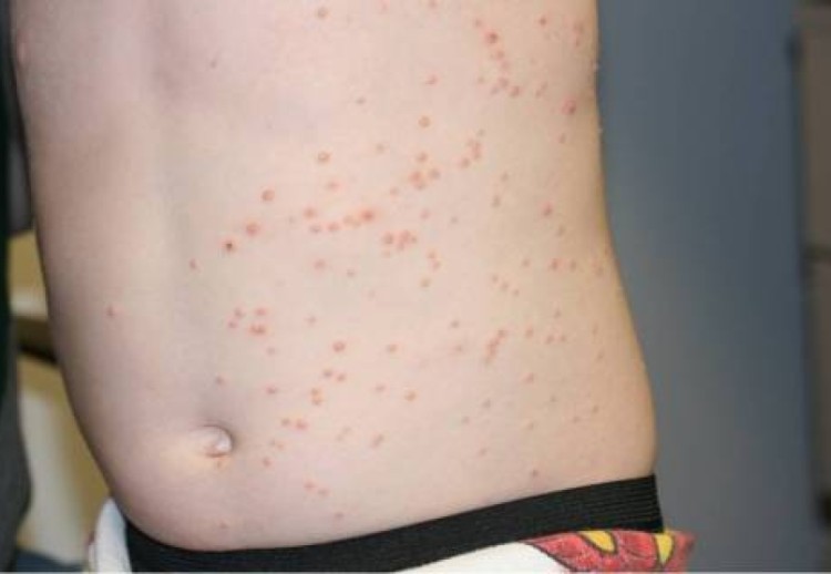 Molluscum Contagiosum: A Common Viral Skin Condition In Children ...