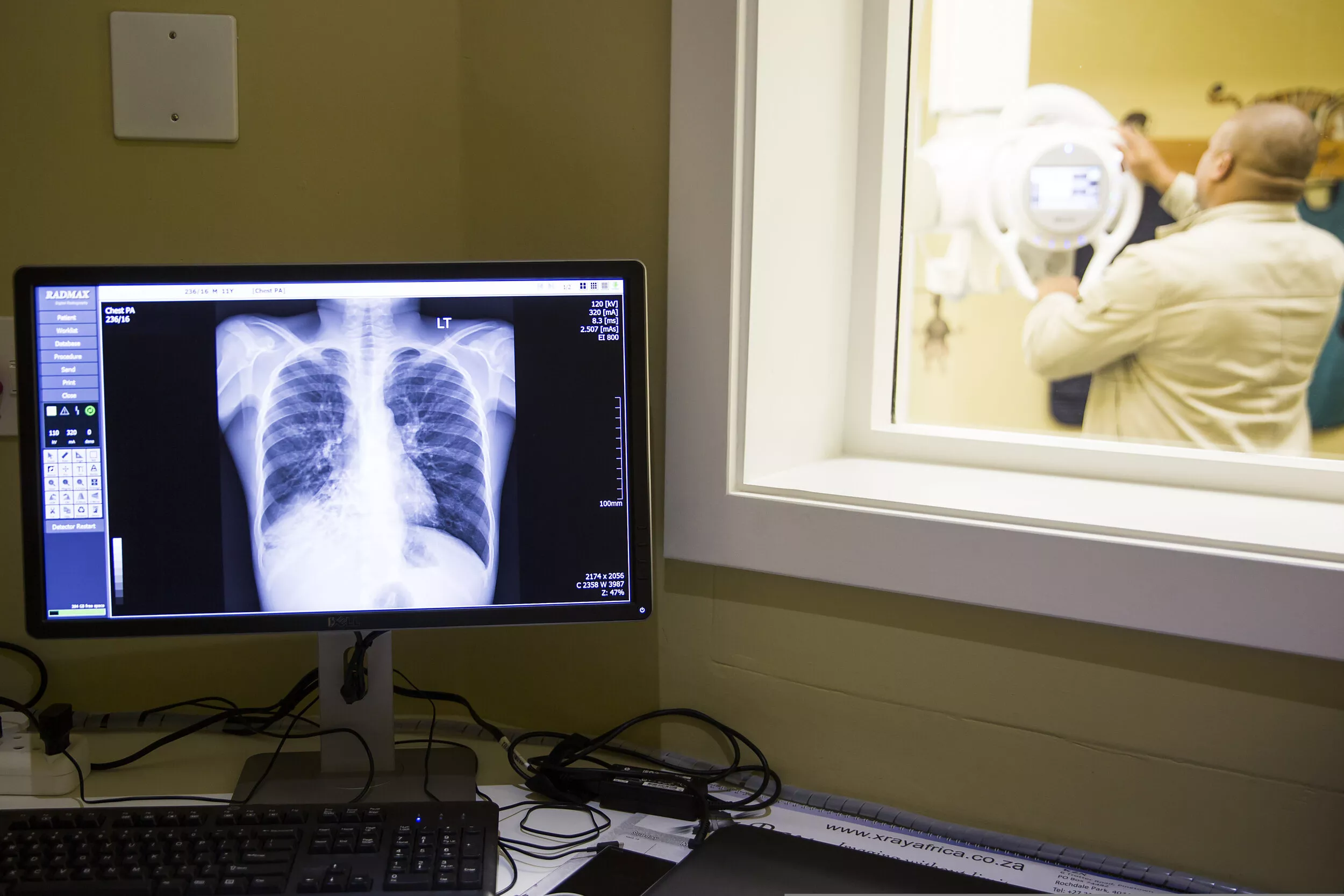 Childhood Tuberculosis (TB) Program | Texas Children's