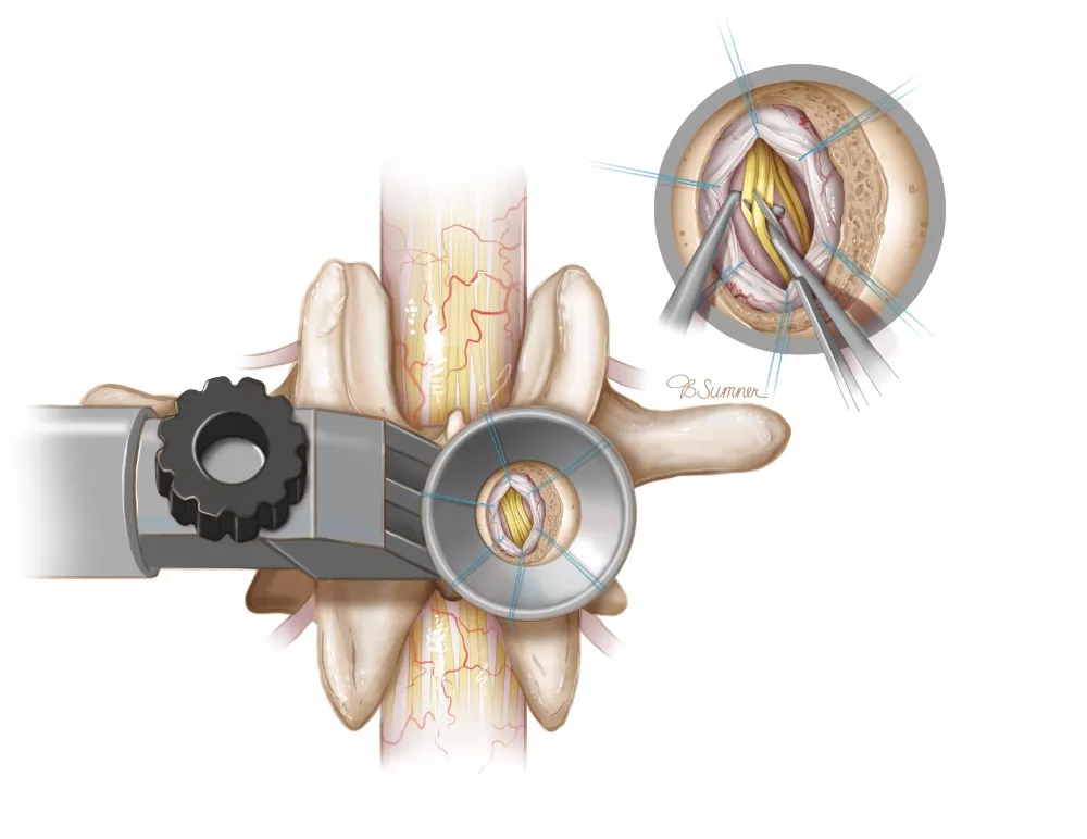 Selective Dorsal Rhizotomy Procedures | Texas Children's
